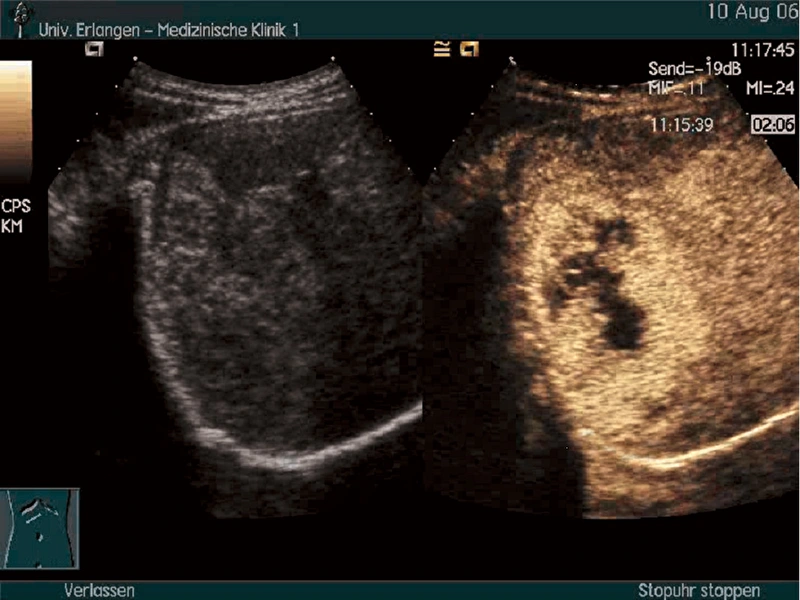 Ultrasound | Bracco